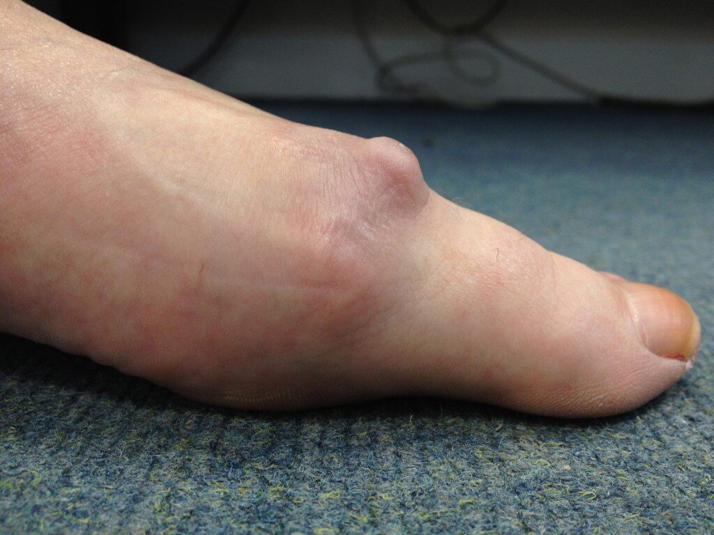 Big Toe Arthritis Hallux Rigidus The London Foot Ankle Clinic Big Toe Arthritis Hallux Rigidus The London Foot Ankle Clinic